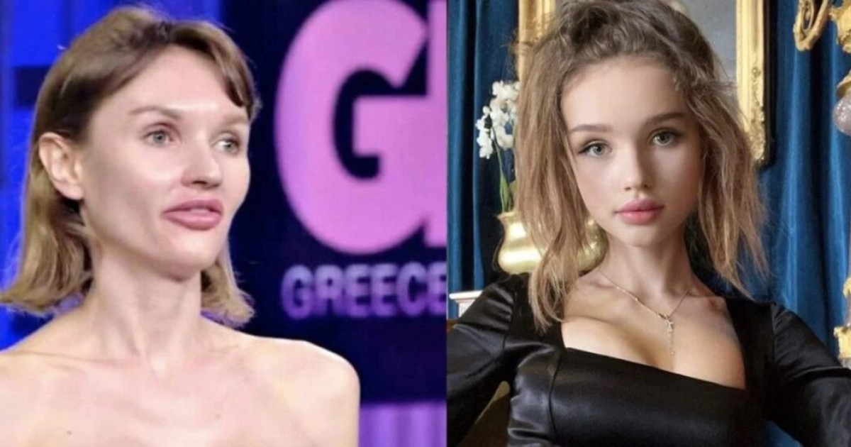 Συνέχισε τις πλαστικές, μοιάζει πλέον 16χρονη Barbie: Αγνώριστη η υποψήφια του GNTM που την ...